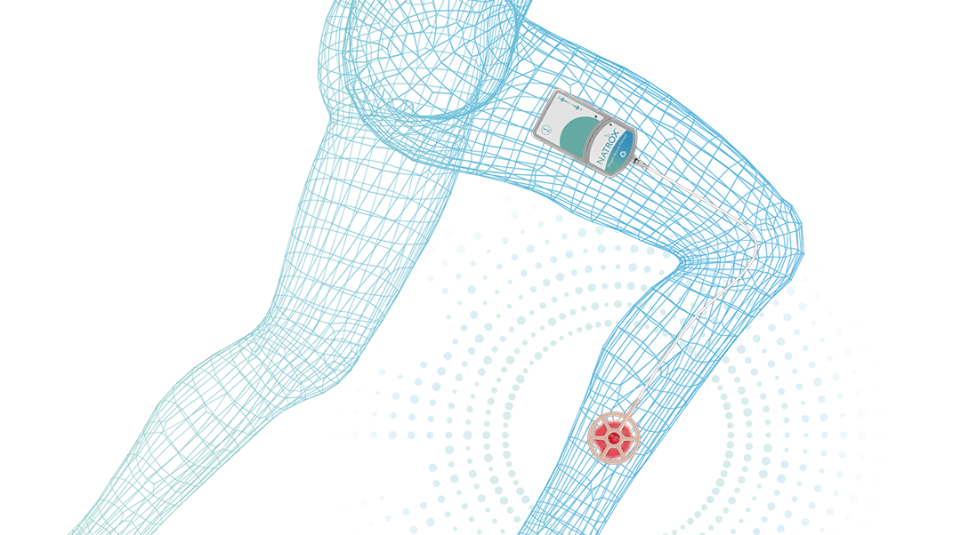 For Patients - NATROX® Wound Care: Supporting clinicians, empowering ...